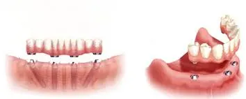 Dental Implants: The All-on-4 Procedure
