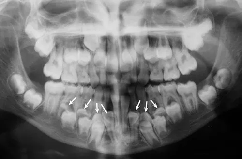 Supernumerary Wisdom Teeth