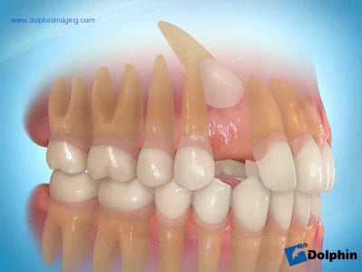 What is a tooth uncovering and chain and bracket procedure?