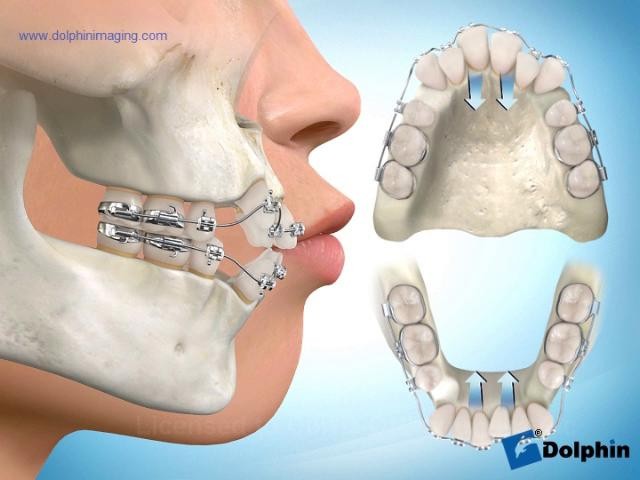 Baby Pulling Teeth For Braces