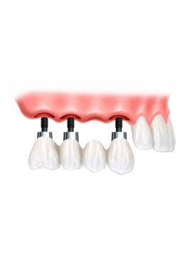 Implant Bridge Chicago Illinois, ORA ® Oral Surgery & Implant Studio
